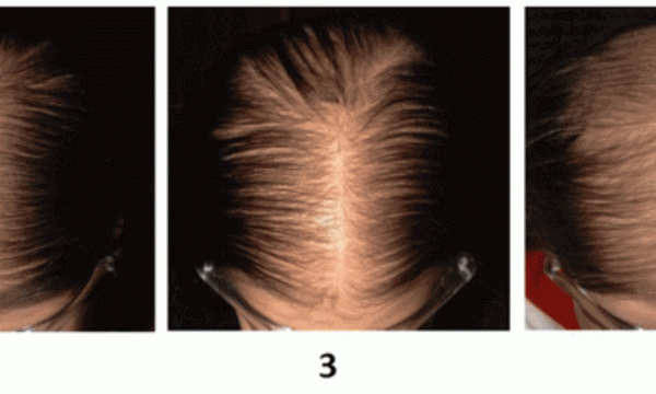 Hair Loss Vitamin D Deficiency: Regrowth Breakthroughs! - Health & Fitness