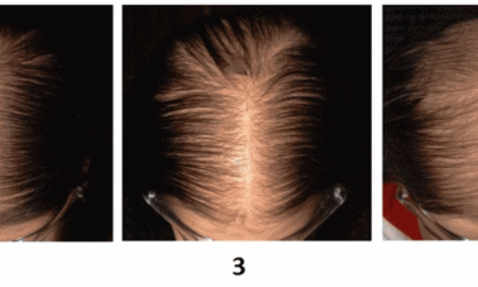 Hair Loss Vitamin D Deficiency: Regrowth Breakthroughs! - Health & Fitness
